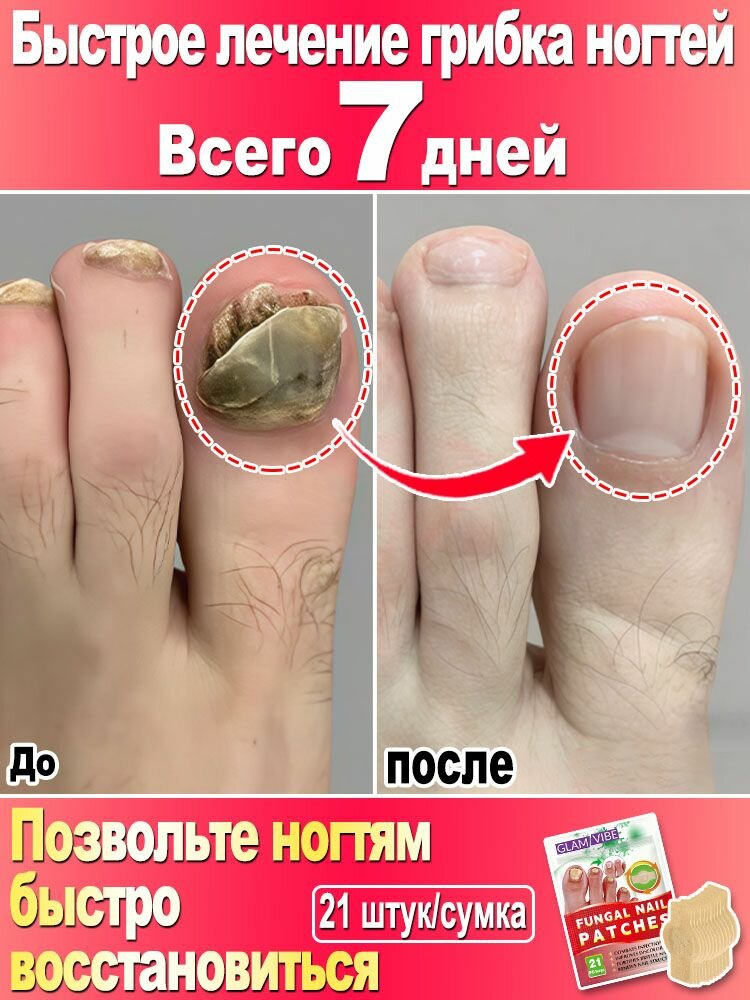 Очаги онихомикоза. 210 очагов.