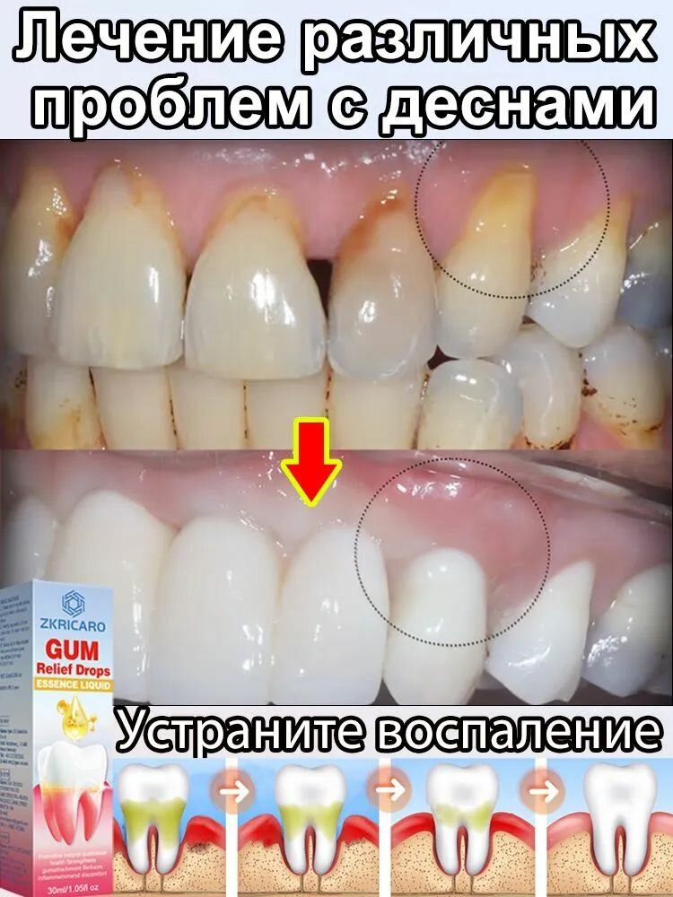 Масло для ухода за полостью рта при рецессии десен, повышенной чувствительности зубов, стоматите и для ухода за деснами. Укрепляет зубную эмаль.1PC