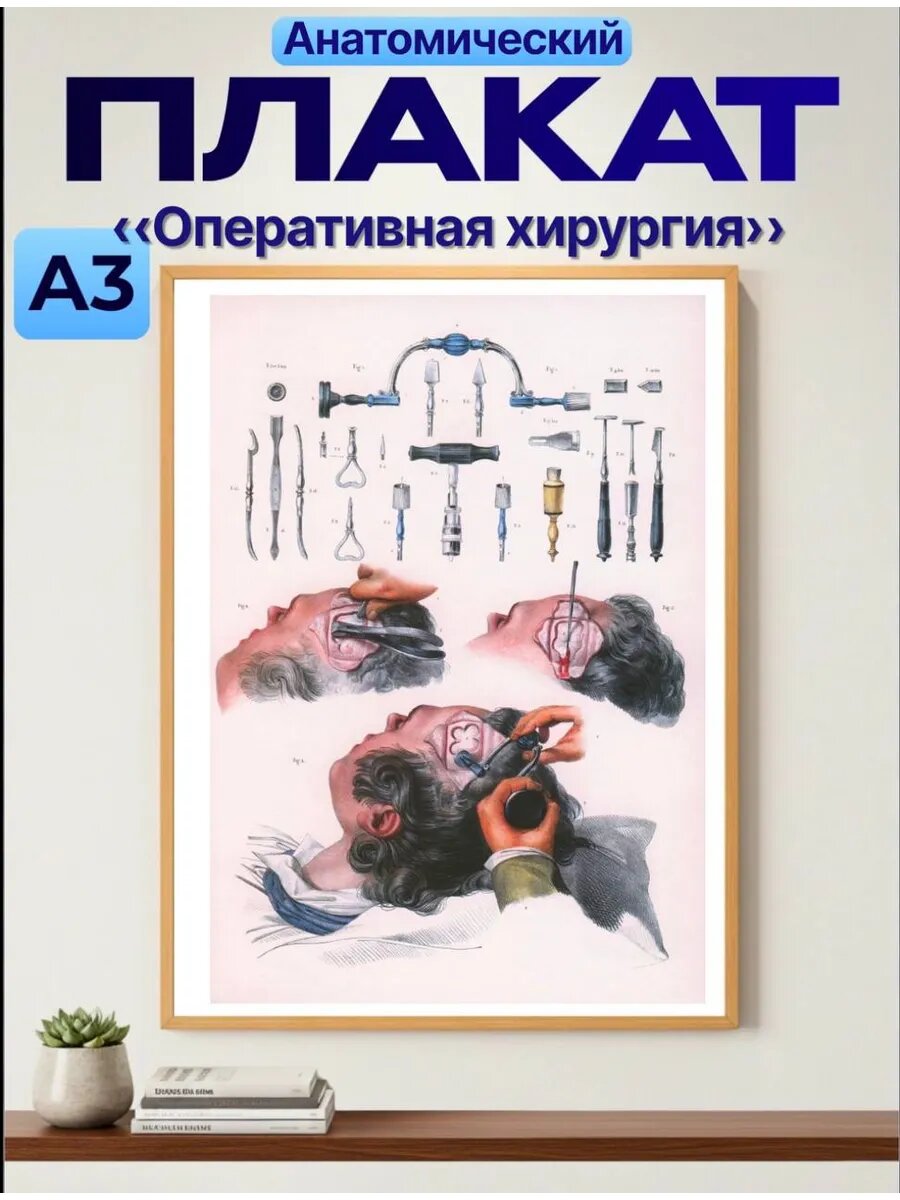 Постер медицинский, трепанация, оперативная хирургия, А3 анатомия, хирургия