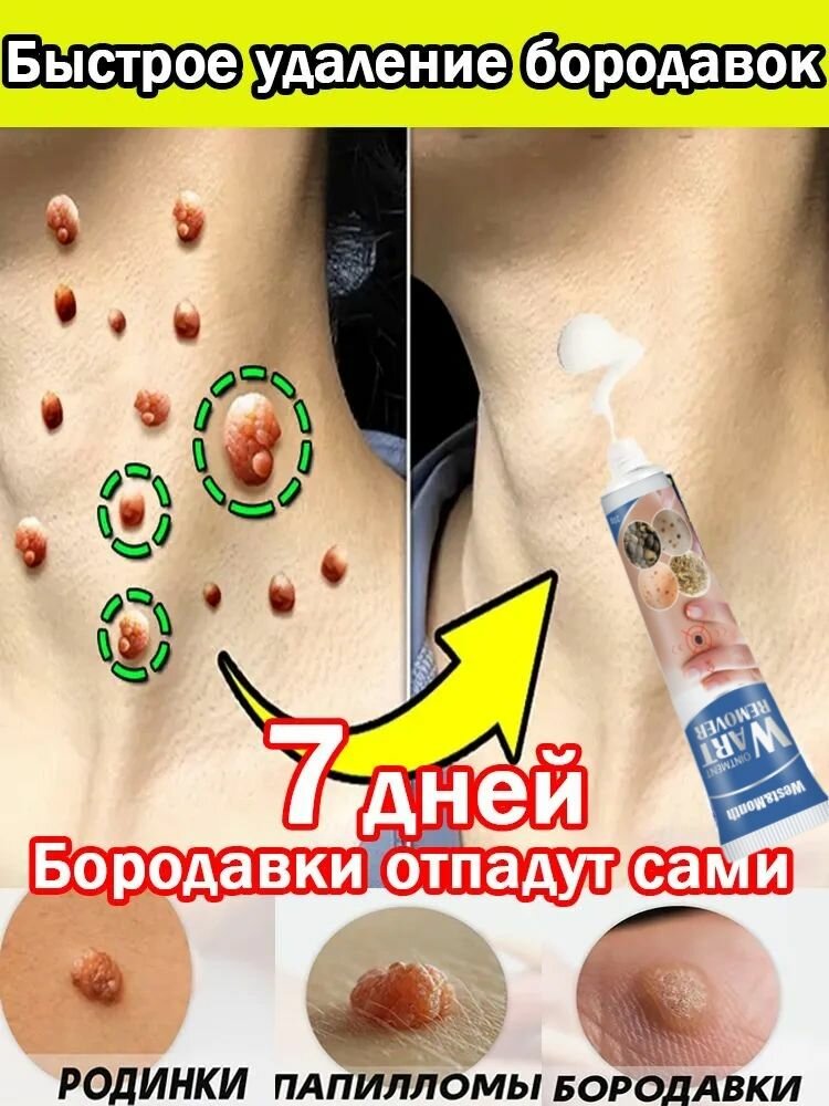 Крем для безболезненного устранения плоских и нитевидных бородавок, папиллом, остроконечных кондилом, родинок и подошвенных бородавок,20г