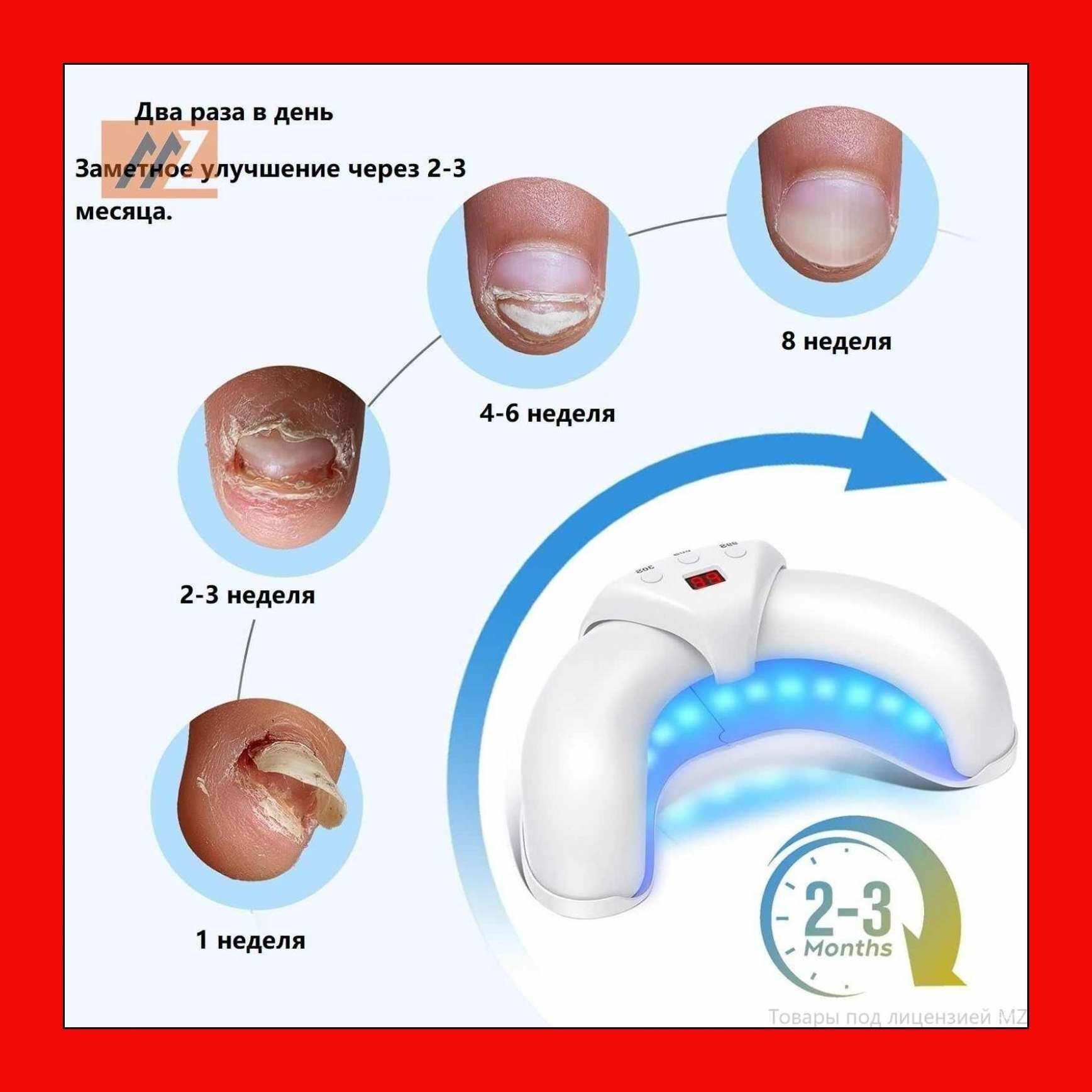 Эксклюзивный аппарат для лазерной терапии онихомикоза: эффективное и безопасное лечение нескольких ногтей на ногах в домашних условиях.