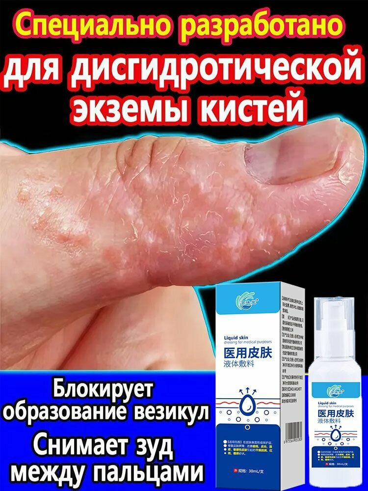 Мазь от экземы на руках от аллергии на коже