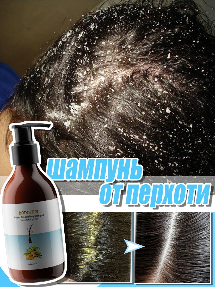 Шампунь от псориаза на голове с экстрактом имбиря, средство для мужчин и женщин, 300 мл