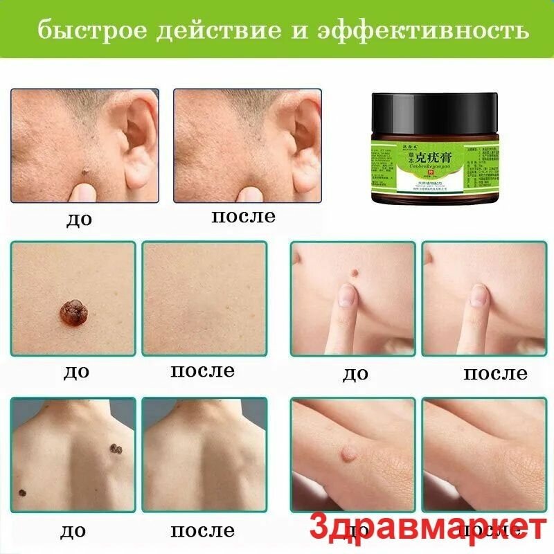 Крем от бородавок, для удаления бородавок папиллом, сухих мозолей на ногах и теле, чистотел, 20 гм