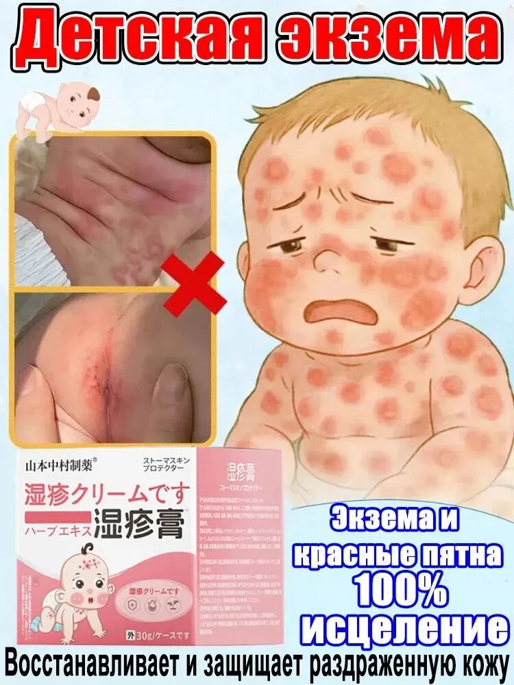 Крем от экземы и атопического дерматита для детей, Детский крем от дерматита, экземы, опрелостей, диатеза, потницы, под подгузник, Устраняет зуд и шелушение, китайская чудо мазь.30 г