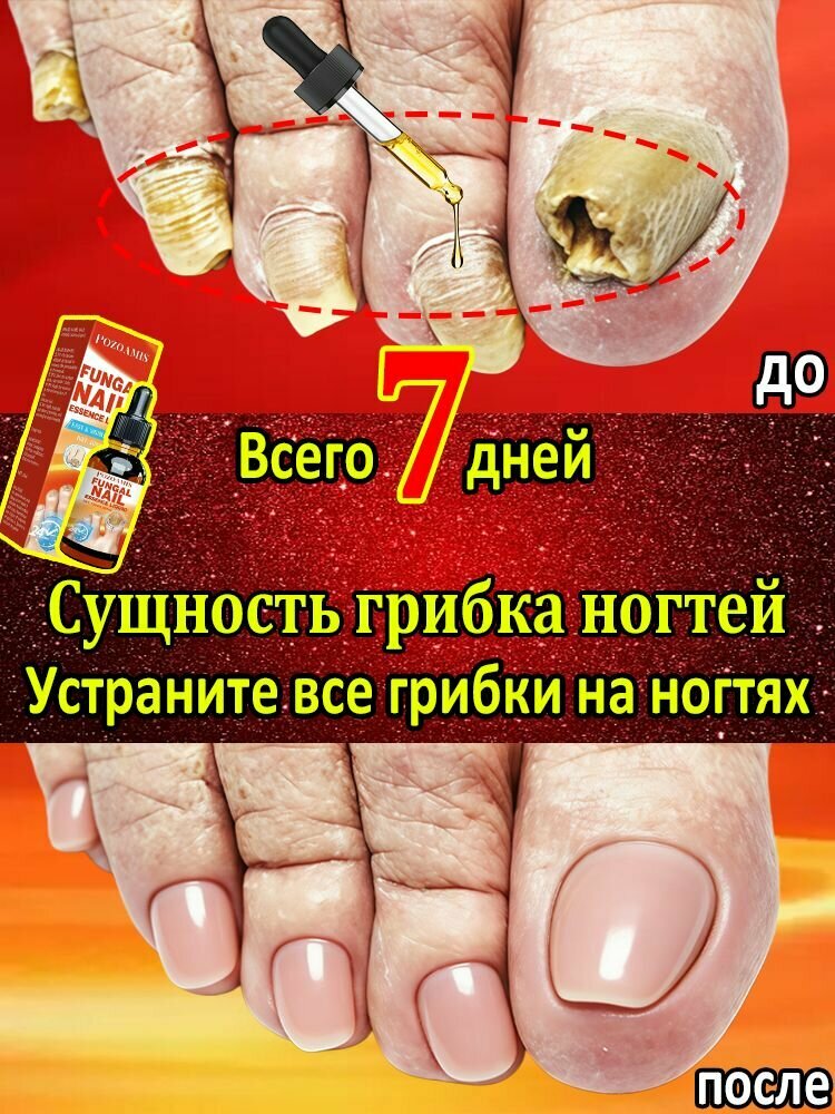 Он подходит для лечения онихомикоза рук и ног, быстрого устранения грибка ногтей, профилактики и лечения онихомикоза и стимуляции роста ногтей. Ингредиенты мягкие и не вызывают раздражения.10 мл