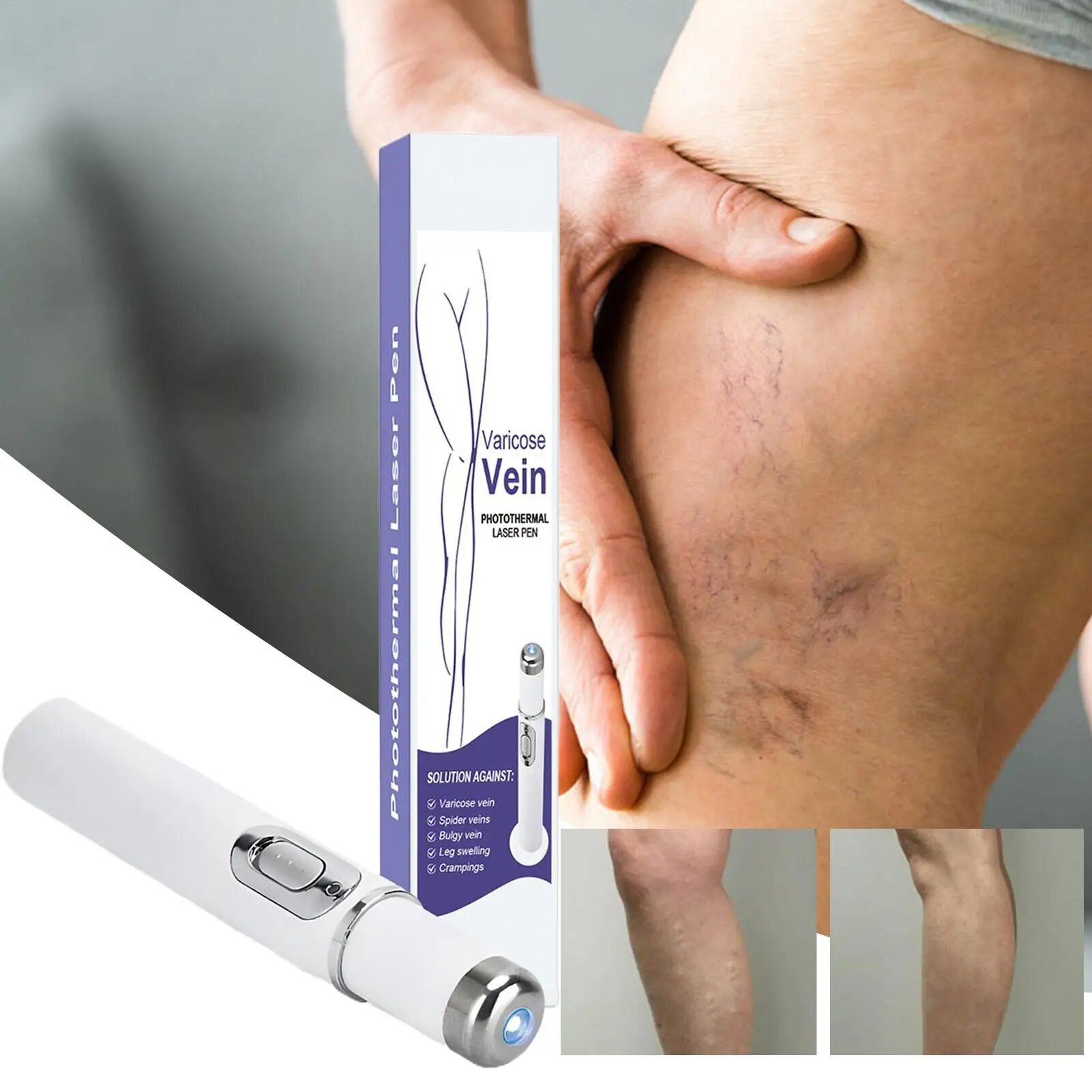 Ручка для удаления сосудистых звездочек Spider Vein Removal Pen