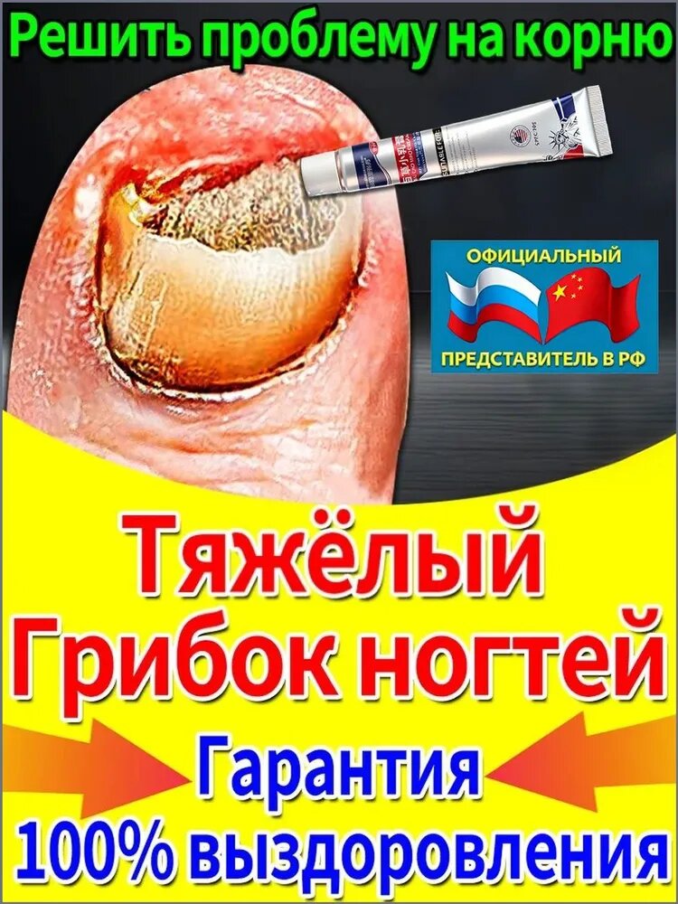 Противогрибковая мазь Ноготок от грибка ногтей на ногах и гиперкератоза, крем для лечения, крем от трещин на пятках, травазол, противогрибковое средство для , корейская мазь для ногтей от онихолизиса