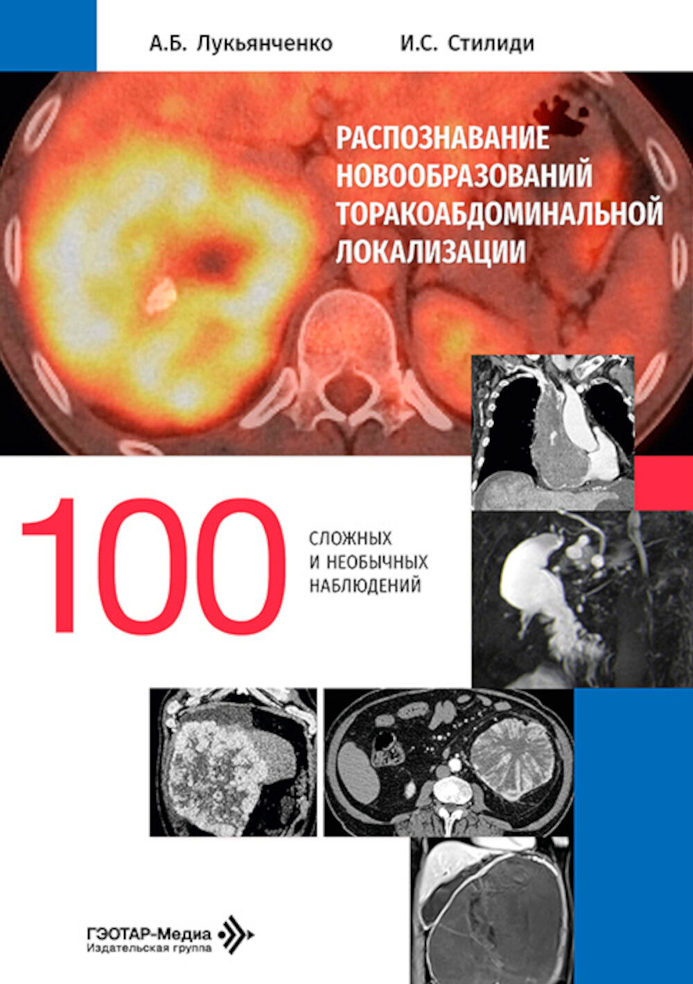 Распознавание новообразований торакоабдоминальной локализации: 100 сложных и необычных наблюдений. Стилиди И. С, Лукьянченко А. Б.
