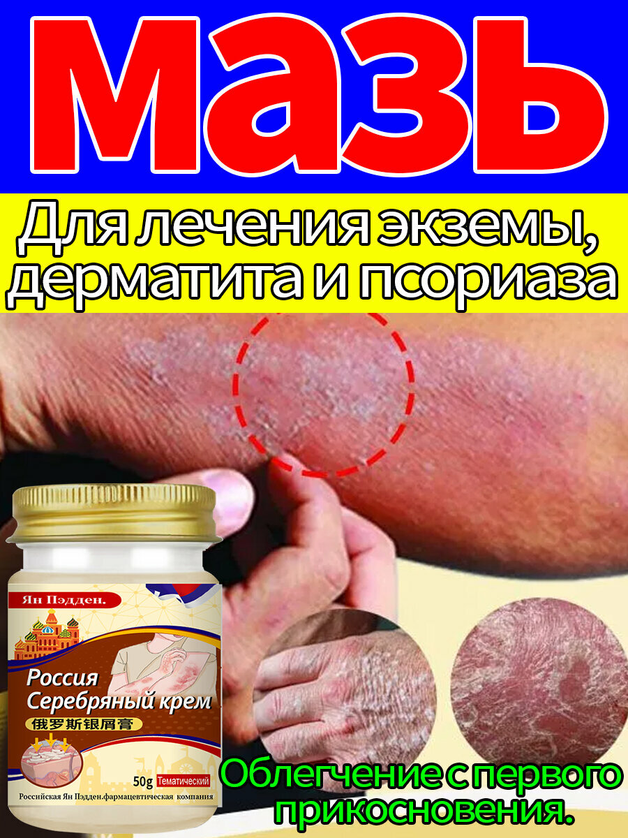 Мазь от зуда для лечения псориаза, экземы и дерматита