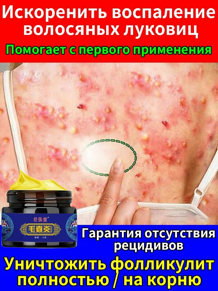 Мазь от фолликулита и прыщей на коже головы натуральный для восстановления волосяных фолликулов, снимает зуд и воспаление,30 мл