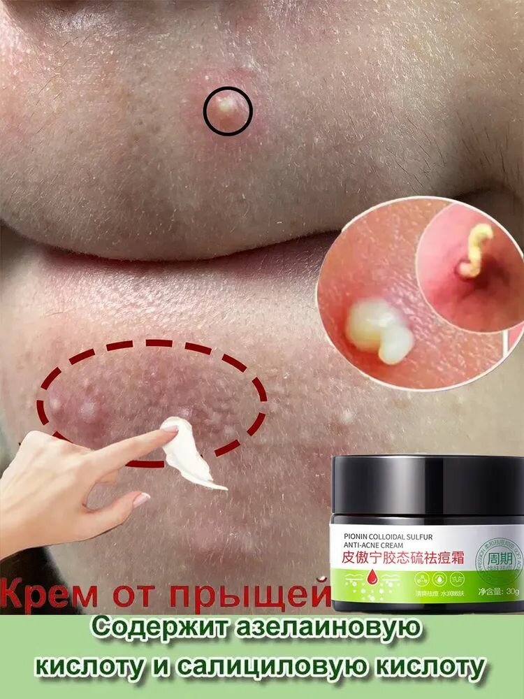 Противовоспалительный крем от угрей и угревой сыпи, подходит для жирной и склонной к акне кожи, 30 мл