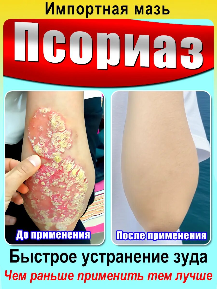 Мазь от лишая человеку на теле