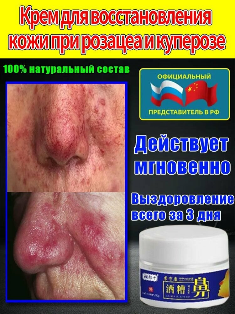 Крем от розацеа на лице купероза и покраснений 30 г