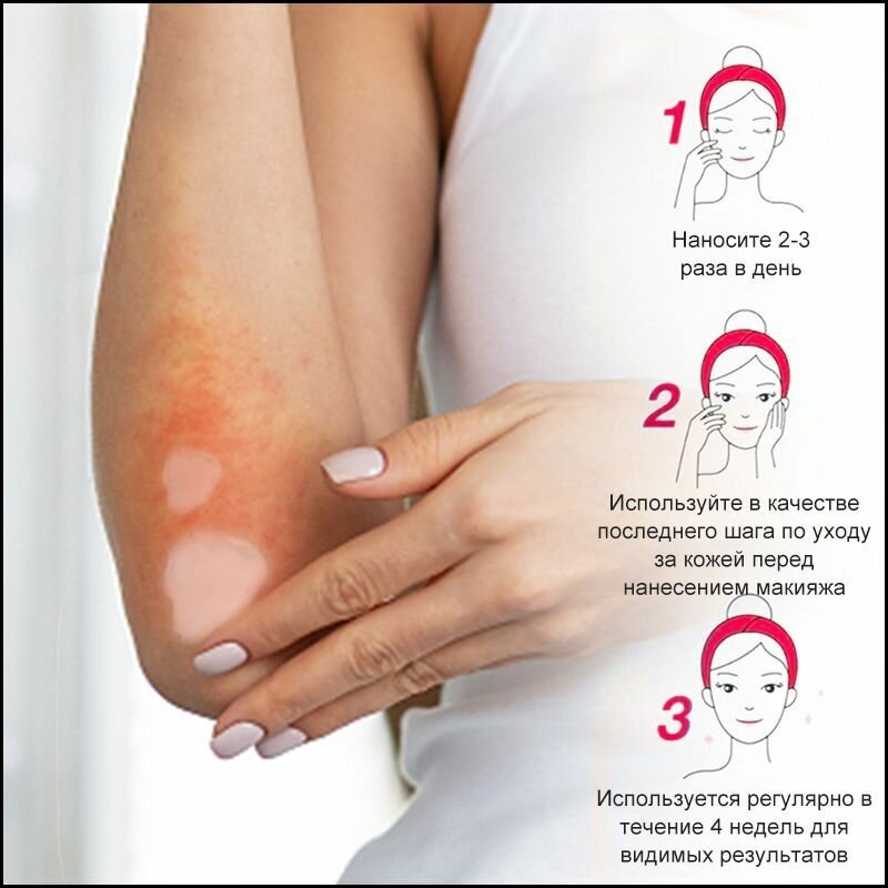 Мазь от псориаза / Крем для ухода за кожей при псориазе, 20 г, экземе и герпесе, акне, ожогах, порезах, от прыщей на лице, укусов насекомых.