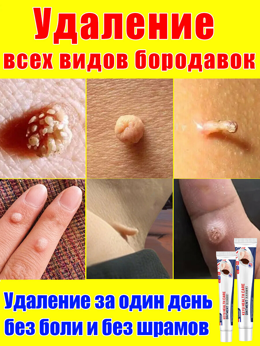 Крем средство для удаления бородавок, папиллом и родинок, безболезненно, не оставляет следов / 20г