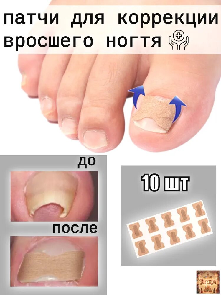 Пластыри для коррекции вросших ногтей на пальцах ног, 10 штук