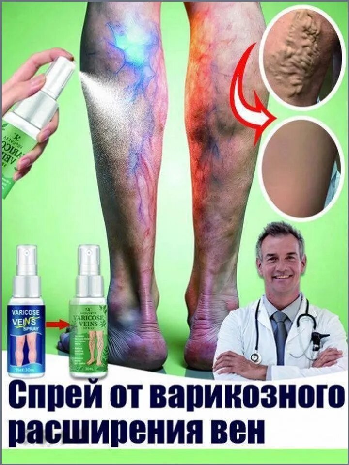 Спрей от варикоза, подходит для лечения отеков и тяжести в ногах, сосудистой сеточки, тромбов, 30 мл.