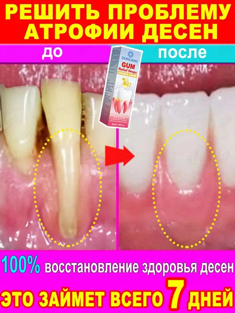 Используется для лечения пародонтита, стоматита, снятия чувствительности и отека десен, восстановления, профилактики и укрепления поврежденных десен, Гигиена полости рта.90 мл.
