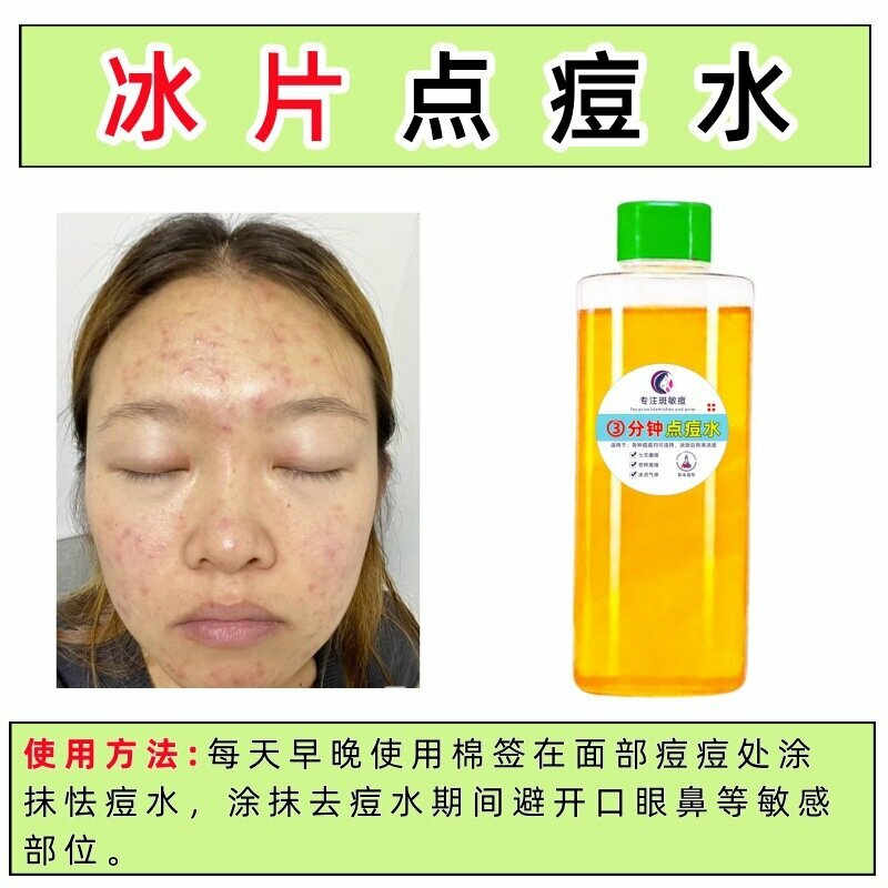 [2026] Средство для лечения акне: прыщей, менструального акне, закрытых комедонов, черных точек и воспаленного акне - эксклюзивно для использования в больницах.