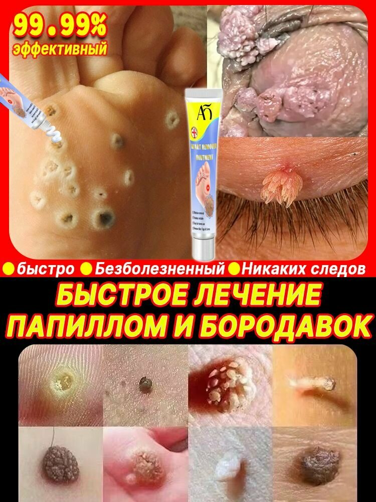 Гель-средство от папиллом, лечение бородавок, удаление родинок, крем от угревой сыпи, безболезненный, не оставляет следов, кожа становится гладкой и увлажненной, 1 шт