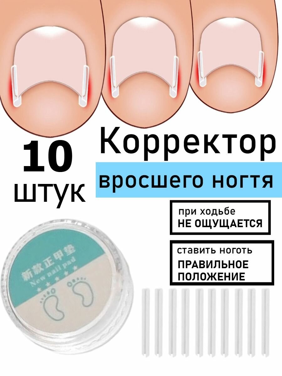 Брекеты Для Вросших Ногтей, Лечение Вросших Ногтей, Облегчение Боли