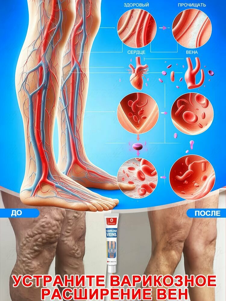 Крем от варикозного расширения вен повышает эластичность венозной стенки и быстро снимает тяжесть и усталость в ногах. Предотвратите обострение варикозного расширения вен.