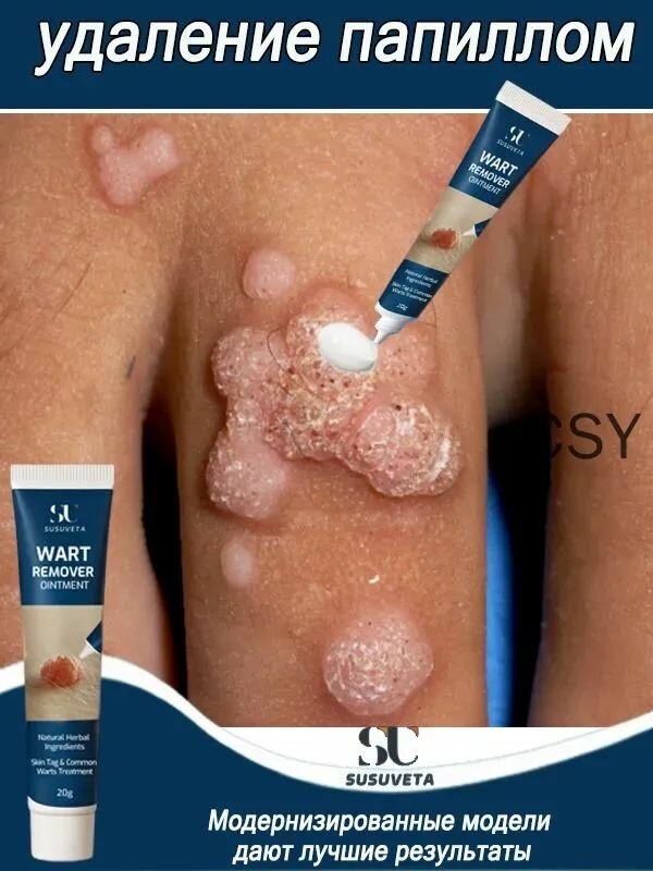 Средство от папиллом и бородавок , для удаления бородавок папиллом, для рук, для шеи, мазь от сухих мозолей, от бородавок / 20 мл