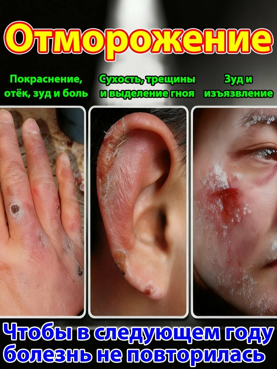 Мазь от сильных трещин и обморожений кожи(для рук, лица и других открытых участков тела от ветра и холода)