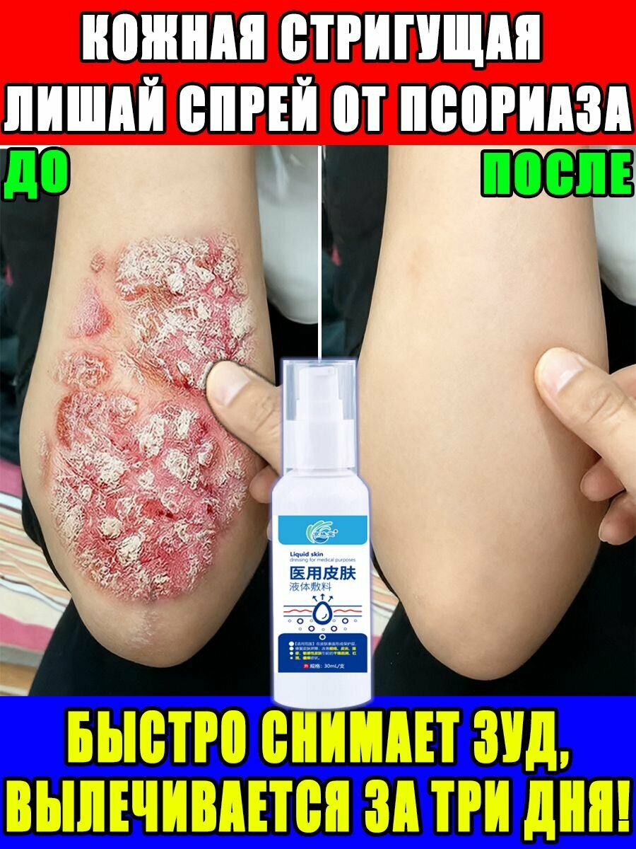Мазь от псориаза эффективная для тела 30 мл