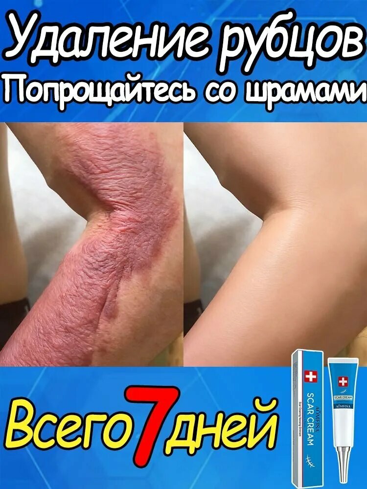 Крем от шрамов. Удаляют различные типы шрамов, ожоги от ножей, хирургические вмешательства, гиперплазию, приподнятые, впалые рубцы и растяжки. Восстанавливает и разглаживает кожу.5 упаковка.