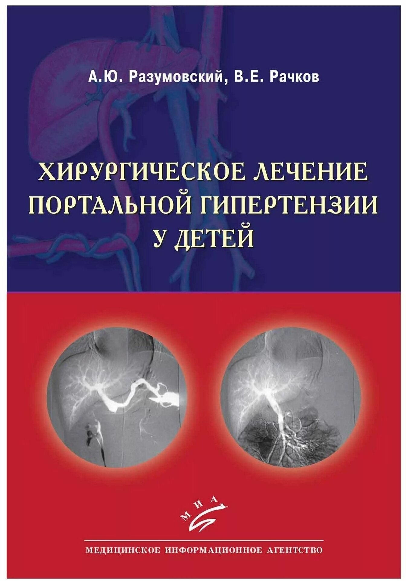 Хирургическое лечение портальной гипертензии у детей