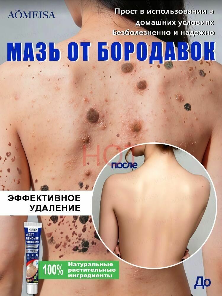 Крем для удаления бородавок. Быстро и безболезненно удаляет все виды бородавок. Подходит для тела, рук и шеи, не имеет побочных эффектов и может восстанавливать дефекты кожи. 20 грамм