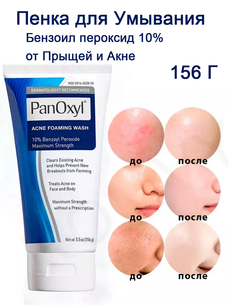 Бензоил пероксид 10% от Прыщей и Акне, Пенка для Умывания,156 Г