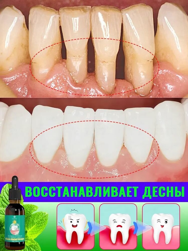 Масло для гигиены полости рта. Быстро лечит опухшие и отступающие десны, пародонтит, снимает чувствительность десен и поддерживает гигиену полости рта. 30 мл