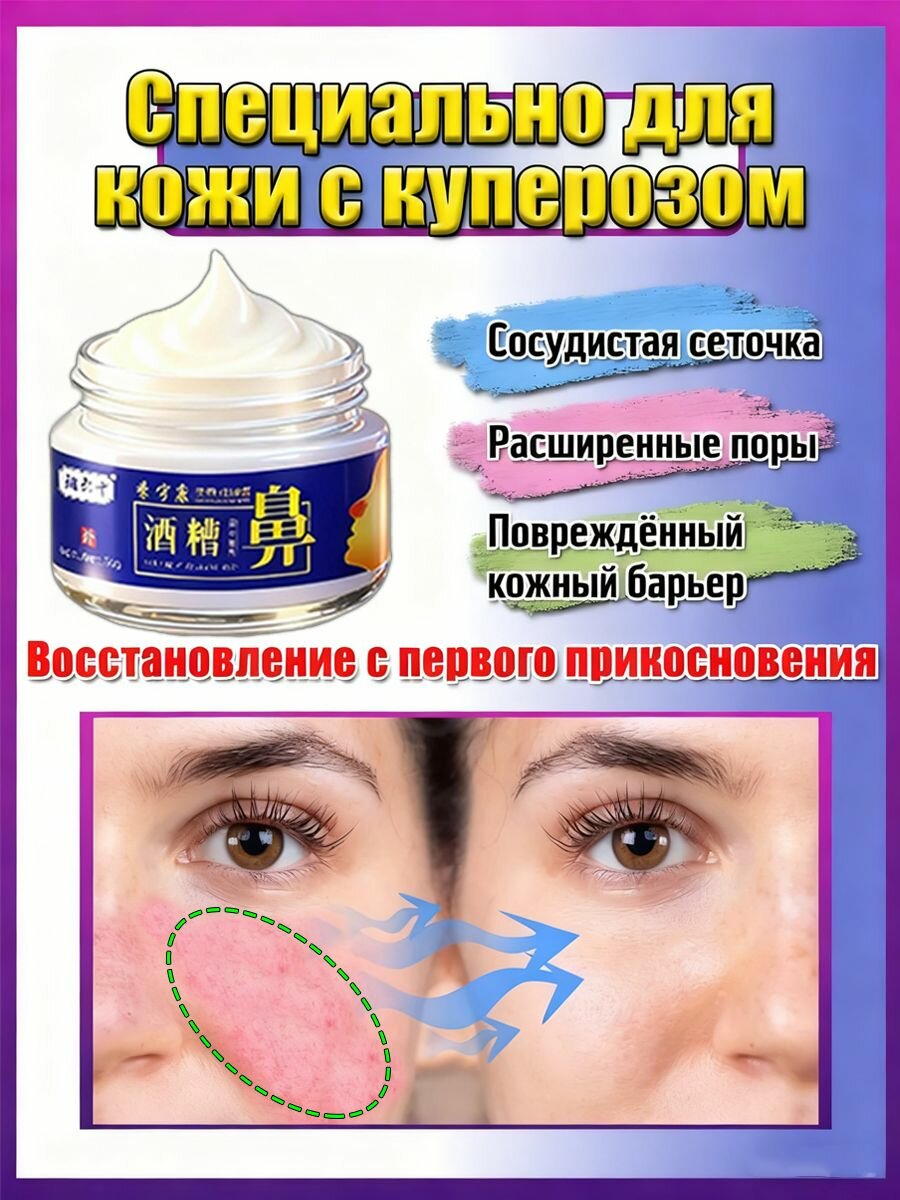 Мазь от Китайский розацеа на лице купероза и покраснений