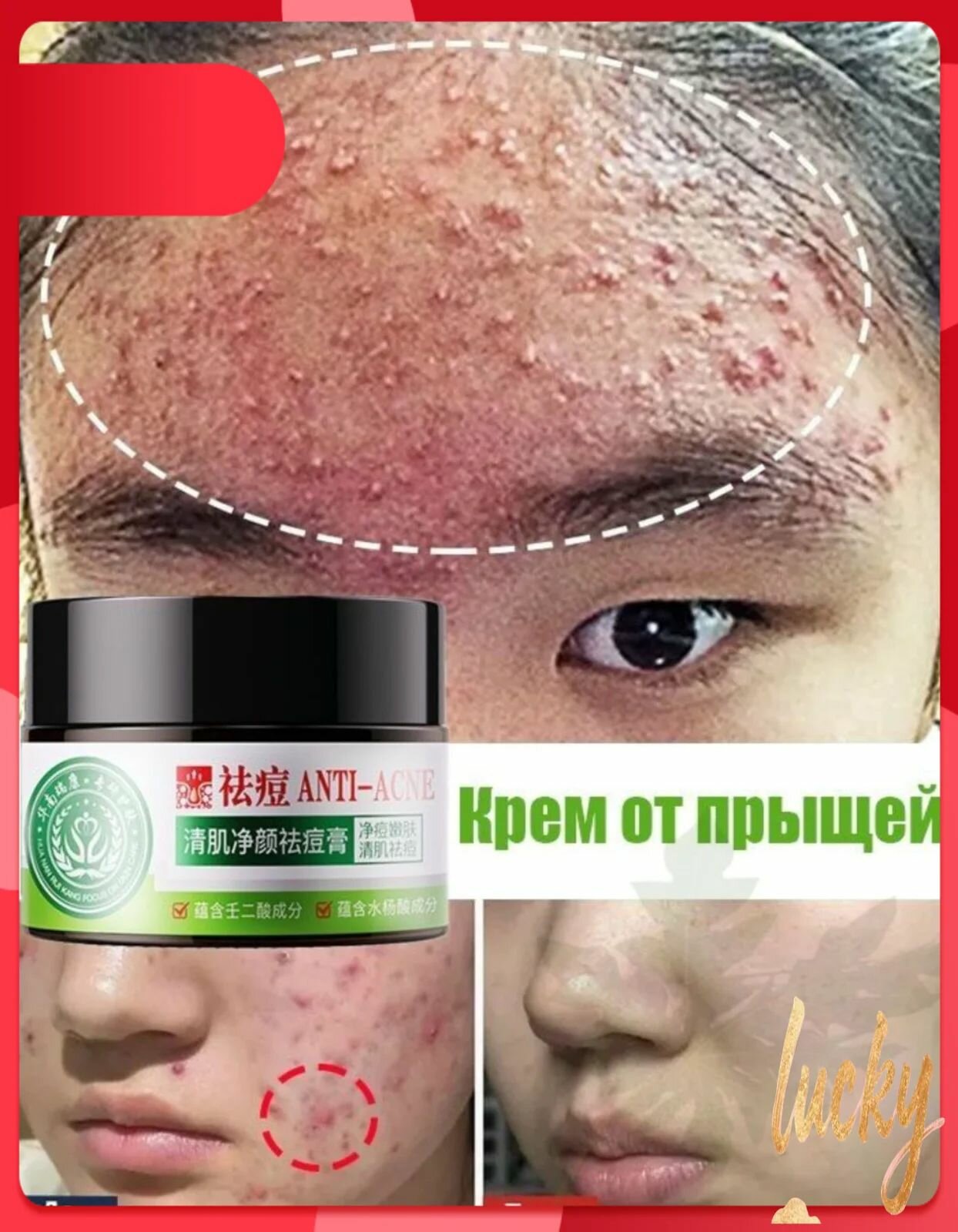 Крем для лица от прыщей на лице с салициловой кислотой и ниацинамидом, эффективное средство от воспалений и угрей, мазь и болтушка от прыщей, 30 г