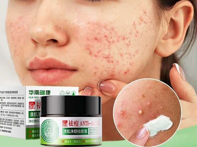 Крем для лица от акне прыщей воспалений, постакне быстрое заживление , для наружного применения, для подростков и взрослых 30 г