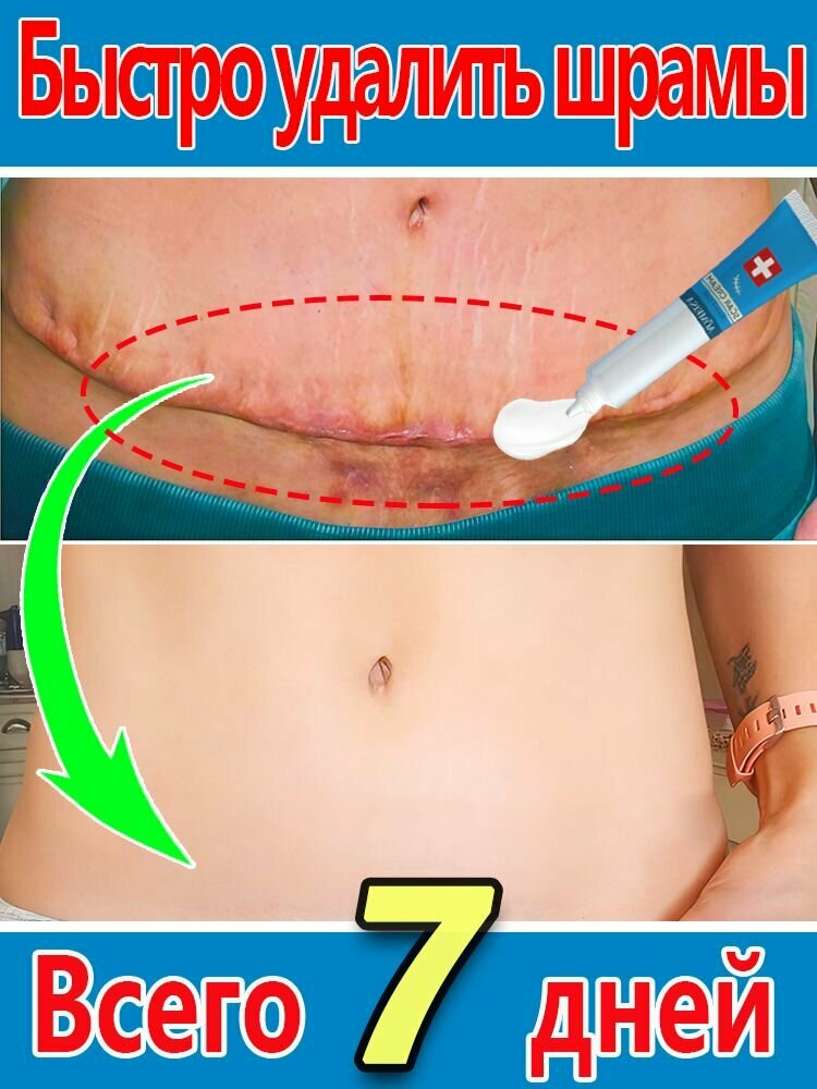 Крем-гель от шрамов, растяжек, травм и пигментации, устраняет рубцы, уменьшает неровности, восстанавливает гладкость кожи, быстро заживляет шрамы.20г