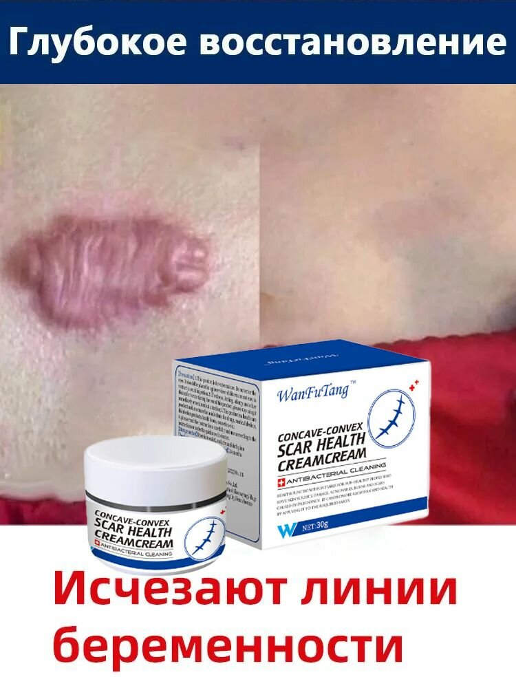 Крем от шрамов и рубцов, от постакне, быстрая починка рубцов Натуральный без побочных эффектов, Удаляет старые и новые шрамы Для лица и тела / 30г