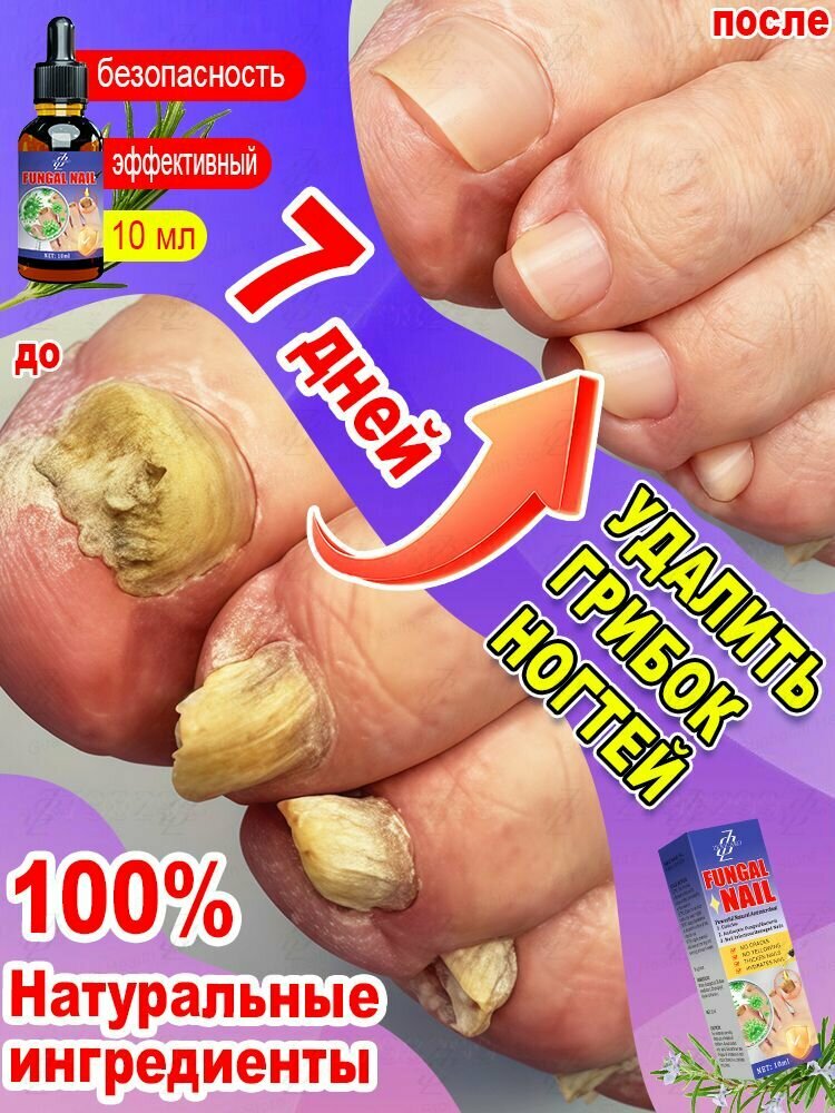 Сыворотка для лечения грибка ногтей и рогового слоя кожи способствует росту и укреплению ногтей, предотвращая их шелушение.10 мл