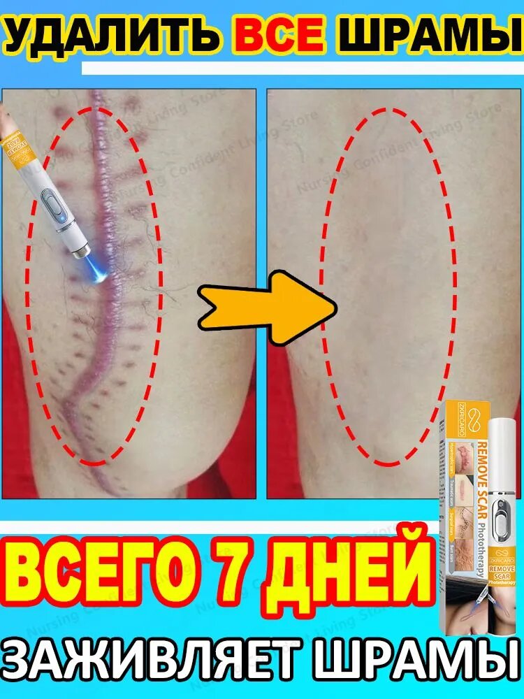 Лазерная ручка для удаления рубцов может удалить гиперплазию, депрессию, послеоперационные и послеродовые рубцы, осветлить пигментацию рубцов, бережно удалить рубцы и разгладить кожу.