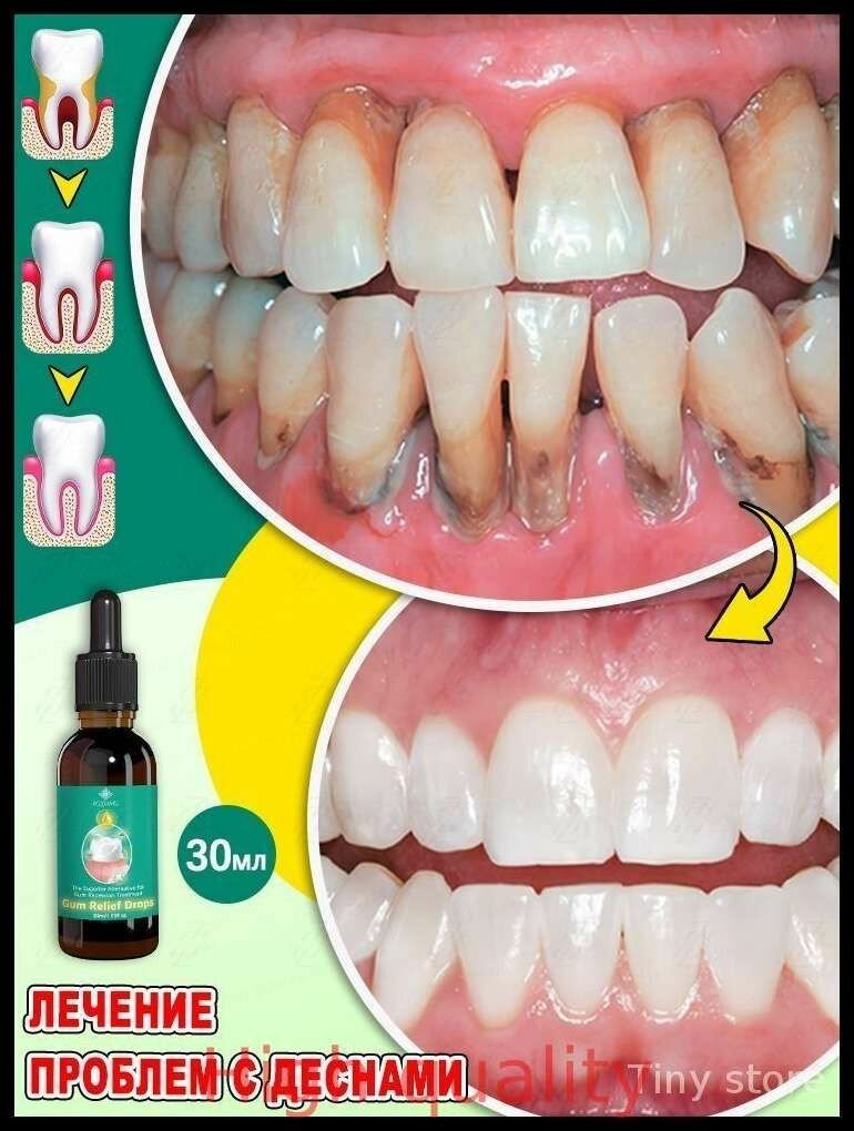 Самый популярный в 2026 годуКапли для лечения десен, устраняет кровоточивость десен, предотвращает атрофию, уменьшает разрывы, Наносите на зубы и десны для комплексного ухода за полостью рта, 30 мл
