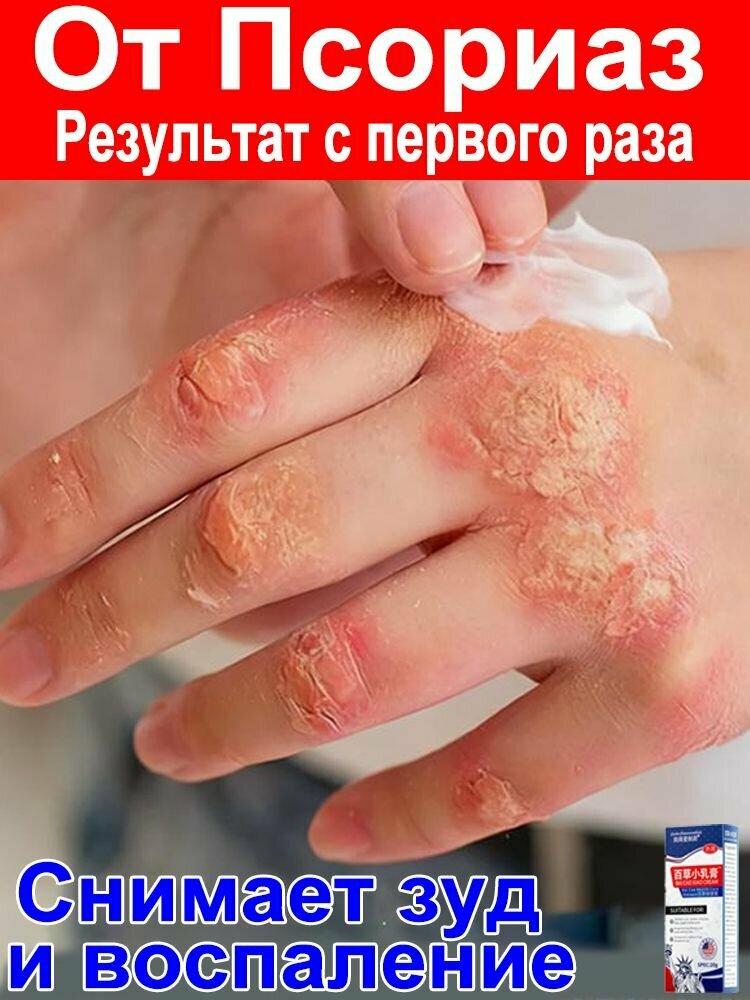 Мазь от псориаза и дерматита, Крем мазь от псориаза, экземы, шелушения кожи и атопического дерматита, китайская чудо-мазь, мазь от псориаза,20 г