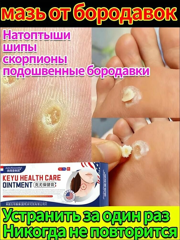 Мазь от шипиц, подошвенных и ладонно-подошвенных бородавок, натоптышей и мозолей на ногах - эффективное удаление и лечение для женщин и мужчин