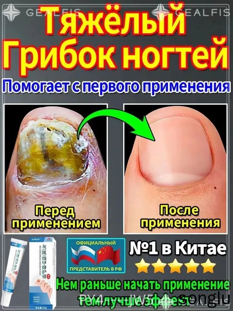 Мазь ноготок от грибка ногтей на ногах, Лечите грибковые инфекции, укрепляйте и восстанавливайте ногти и роговой слой кожи, а также устраняйте грибок ногтей на ногах.