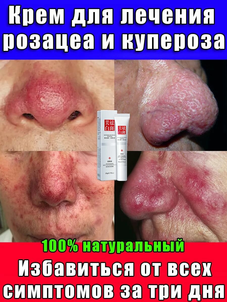 Крем для лица от купероза, розацеа, покраснений "Тонус-Капилляр Лица". для проблемной кожи,100% натуральный В безгормональном составе.20 мл