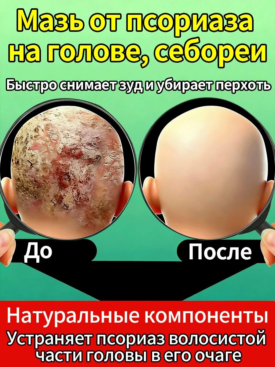 Эта мазь применяется при псориазе, шелушении, покраснении, экземе и дерматите на лице и руках. Быстро снимает зуд и подходит для проблемной кожи. 50 грамм.