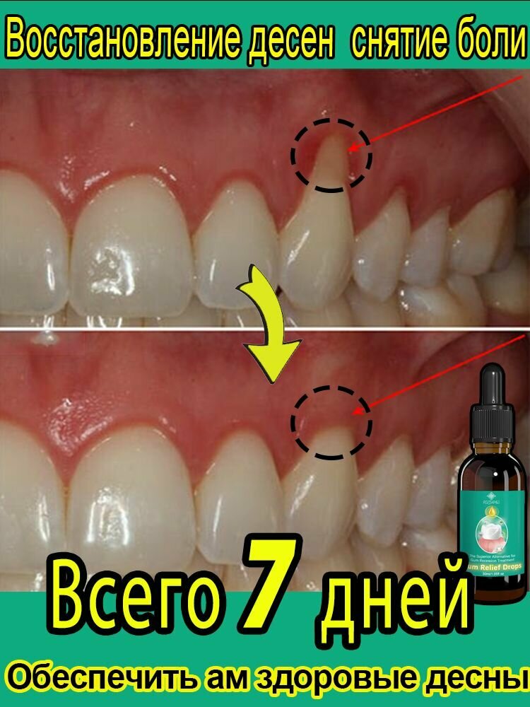 Эфирное масло для ухода за полостью рта при рецессии десен, чувствительных зубах и деснах. Растительные экстракты. Антибактериальное средство для ухода за полостью рта. 30 мл.