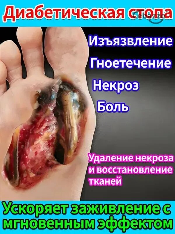 Мазь для лечения диабетической стопы и пролежней: заживление ран и регенерация кожи при сахарном диабете